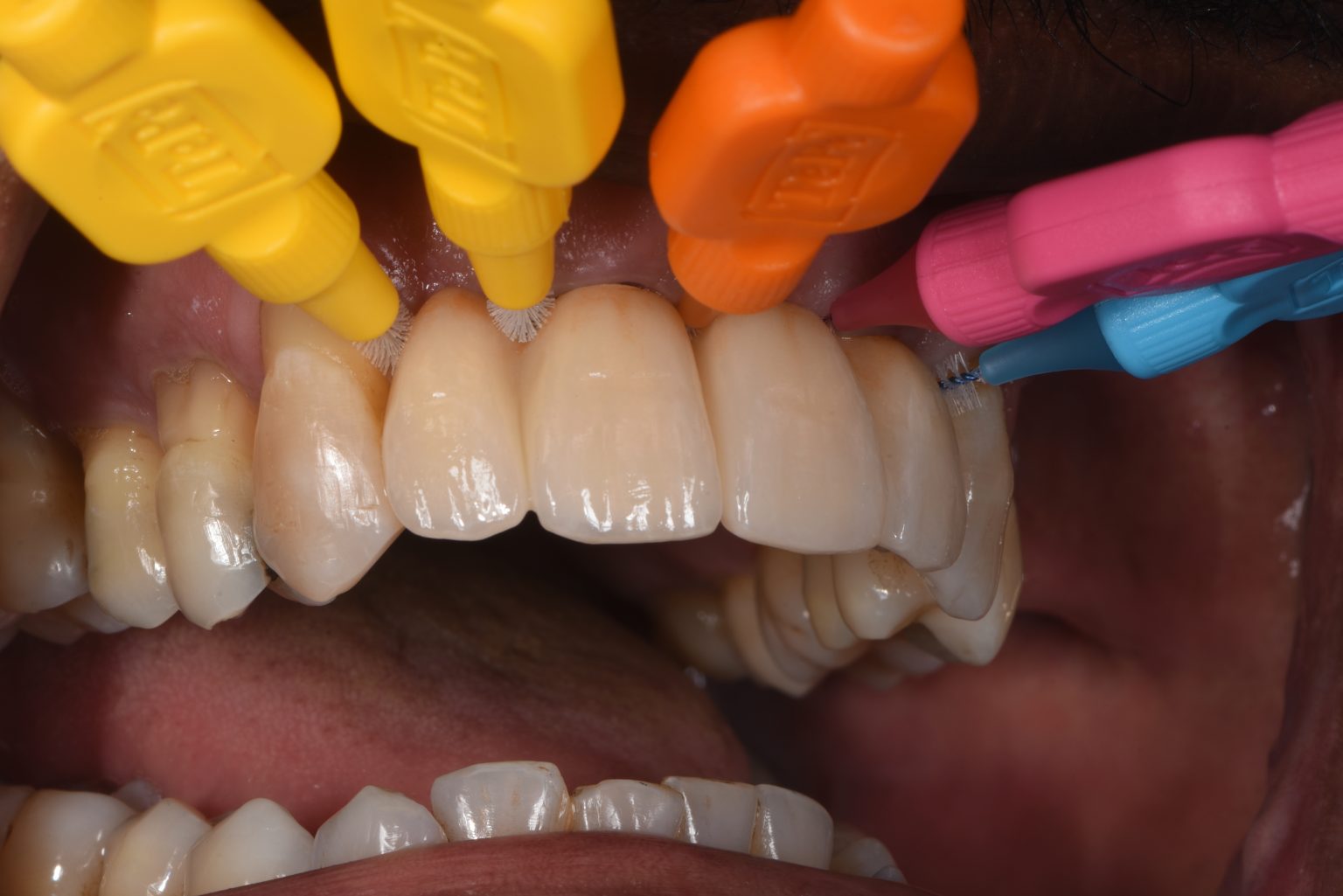 Multidisciplinary care: Utilization of the implant portfolio - ITI Blog