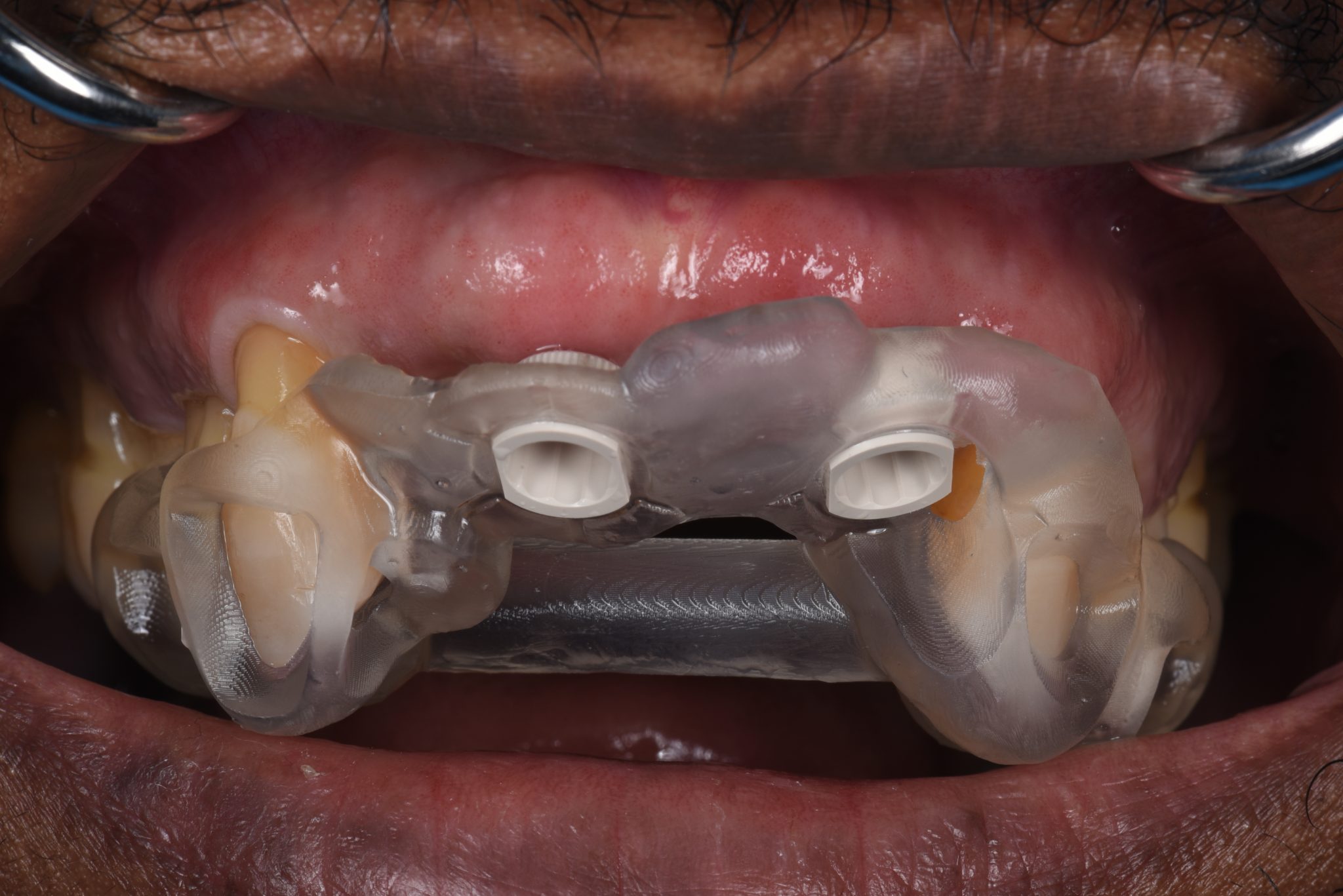 Multidisciplinary care: Utilization of the implant portfolio - ITI Blog