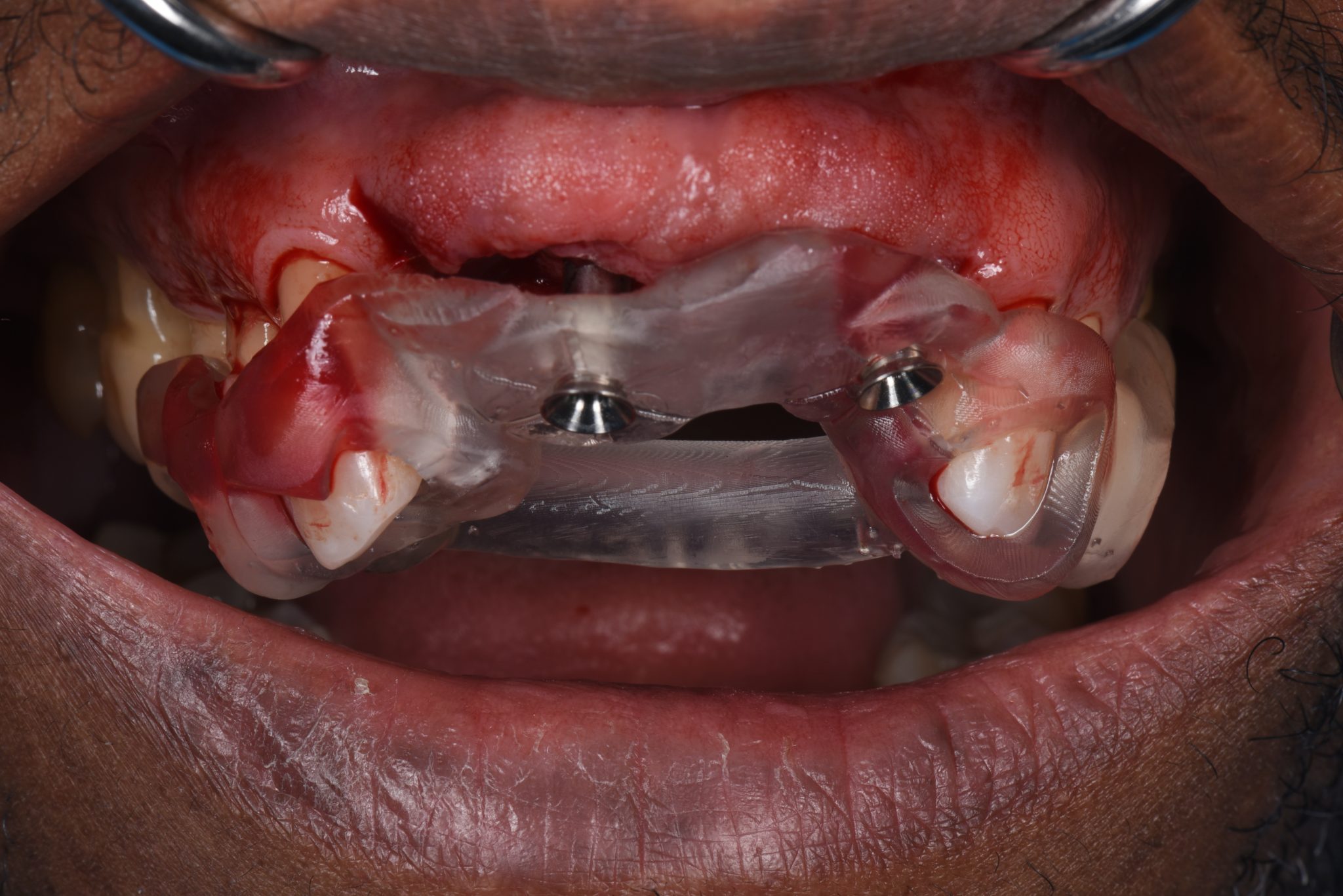 Multidisciplinary care: Utilization of the implant portfolio - ITI Blog