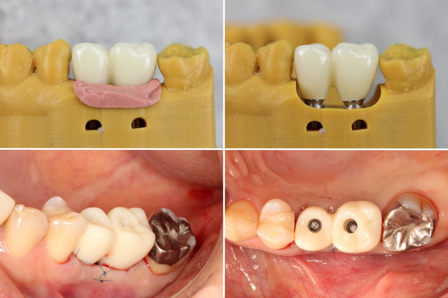 ITI Blog - Clinical applications and advantages of intraoral scanners