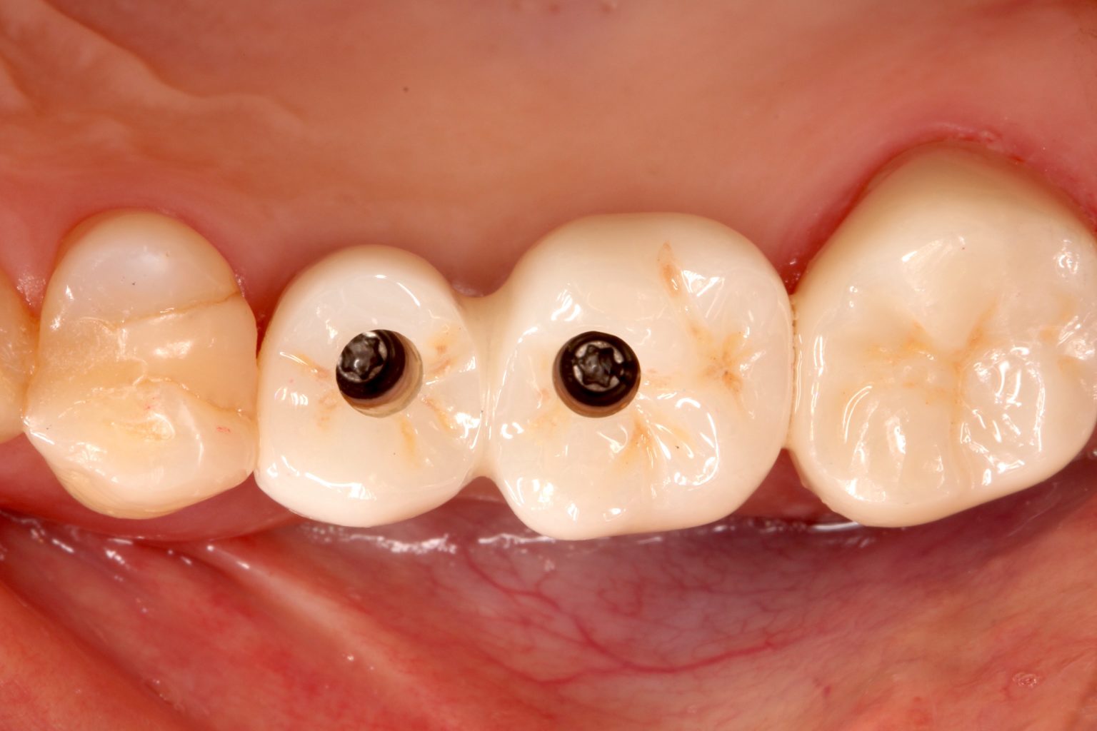 ITI Blog - Clinical applications and advantages of intraoral scanners