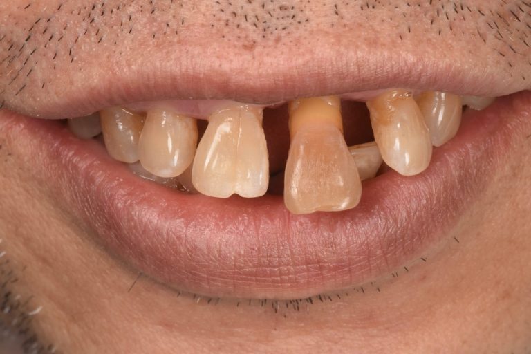 Successful implant placement in the esthetic zone