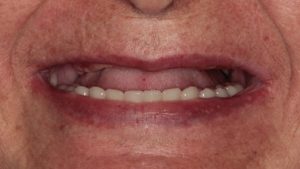 Interocclusal space assessment for full-arch implant-supported ...