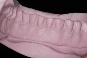 Interocclusal space assessment for full-arch implant-supported ...