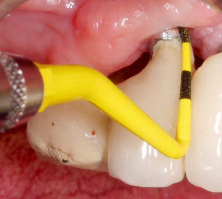 Implantoplasty as adjunct to the surgical treatment of peri-implantitis