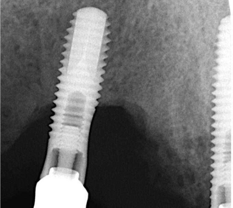 Implantoplasty as adjunct to the surgical treatment of peri-implantitis