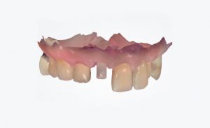 The multi-purpose abutment: the use of a titanium base abutment as a ...