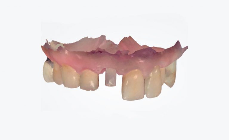 The multi-purpose abutment: the use of a titanium base abutment as a ...
