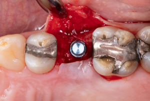 Management of a post-extraction dehiscence defect utilizing a minimally ...
