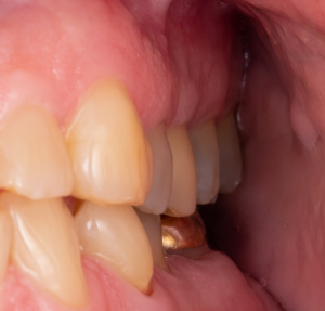 Management of a post-extraction dehiscence defect utilizing a minimally ...