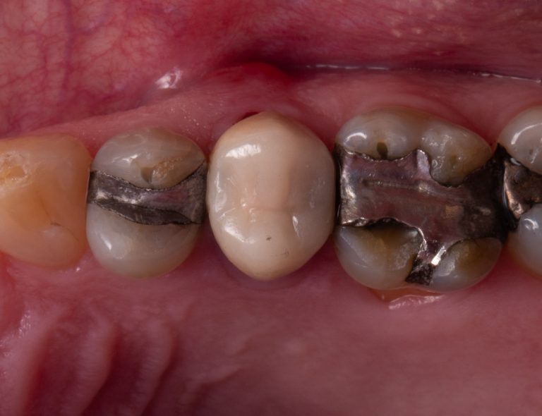 Management of a post-extraction dehiscence defect utilizing a minimally ...