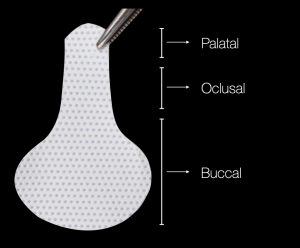 Management of a post-extraction dehiscence defect utilizing a minimally ...