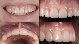 L-shape technique: novel guided bone regeneration with simultaneous ...