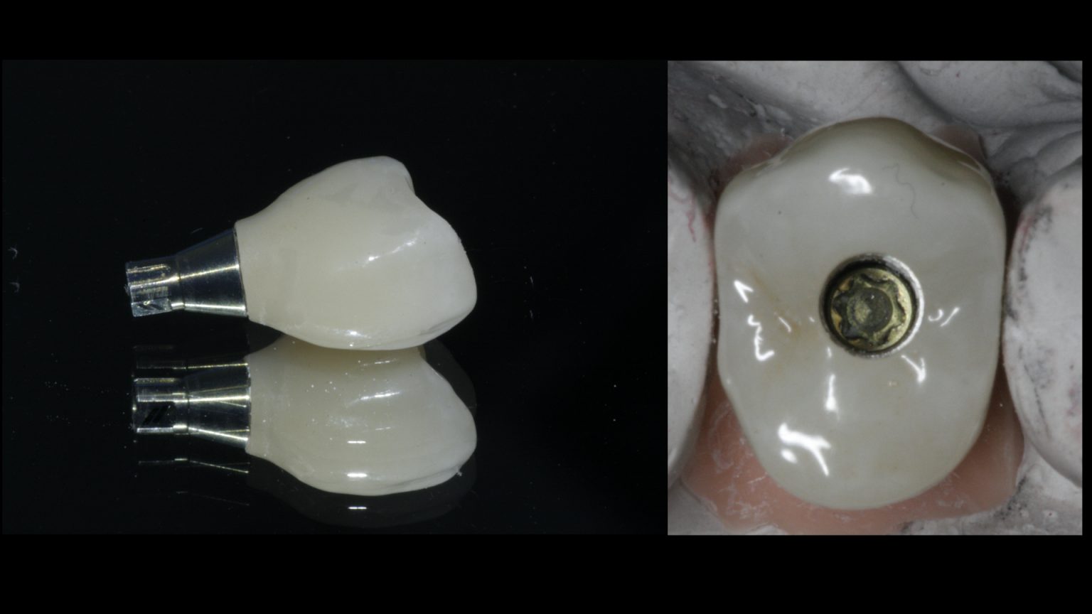 Hybrid abutment-crown for single implant restorations – clinical and ...
