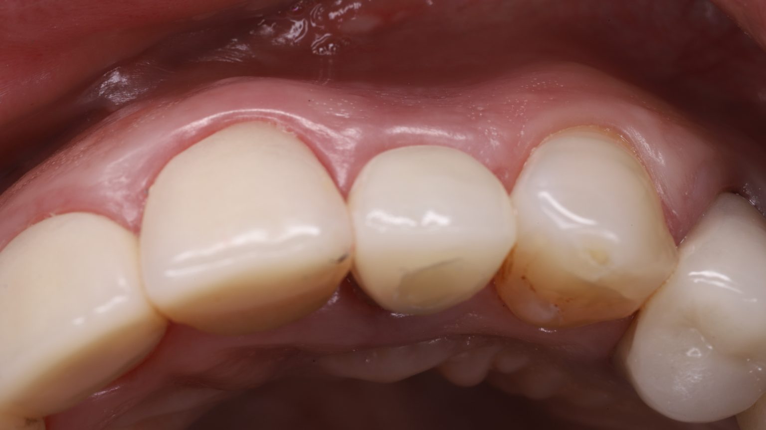 Socket shield therapy: when, where & how? - ITI Blog