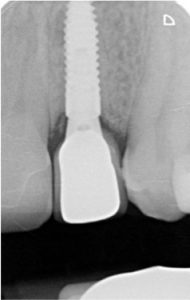 Socket shield therapy: when, where & how? - ITI Blog