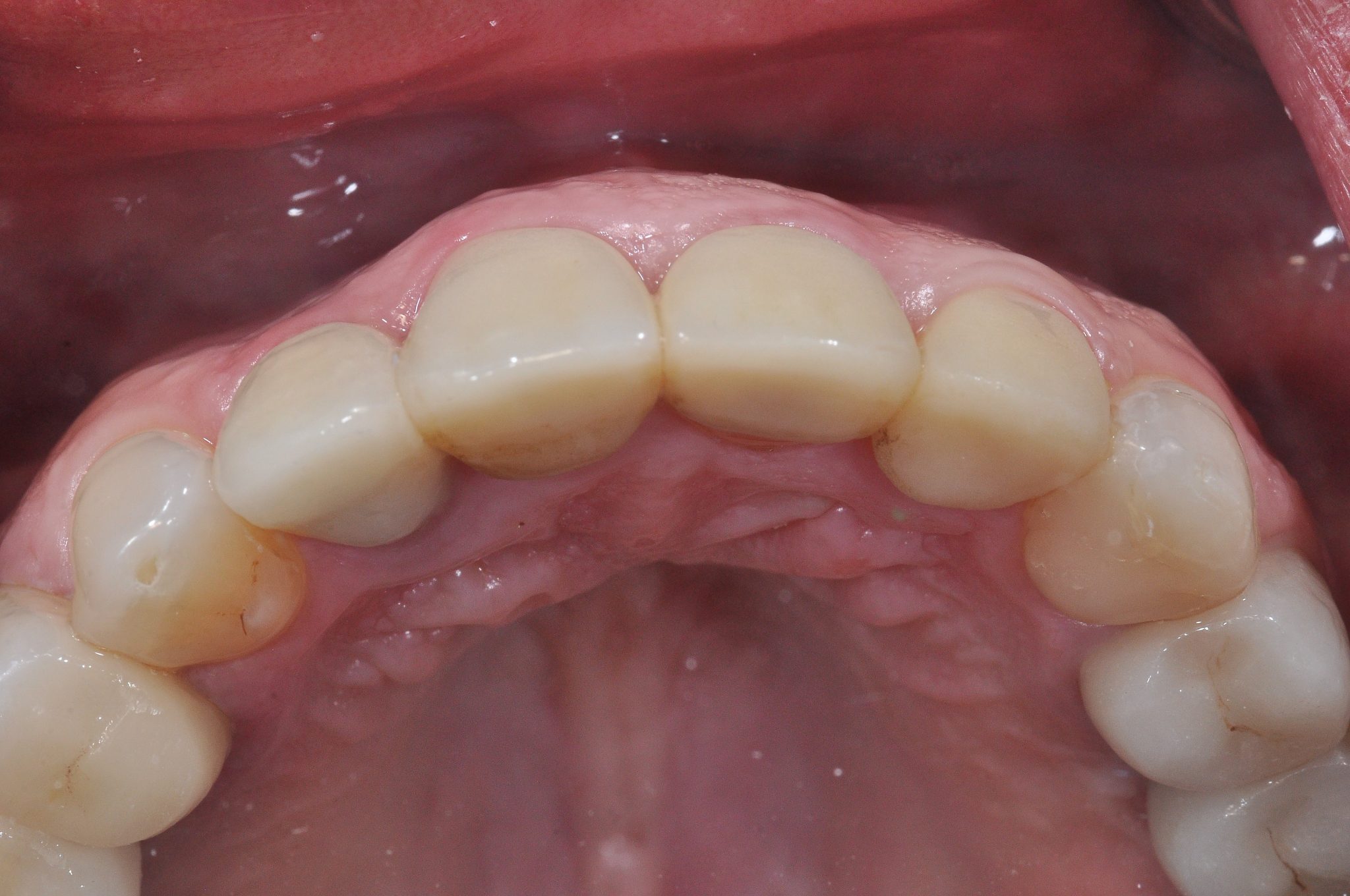 Socket shield therapy: when, where & how? - ITI Blog