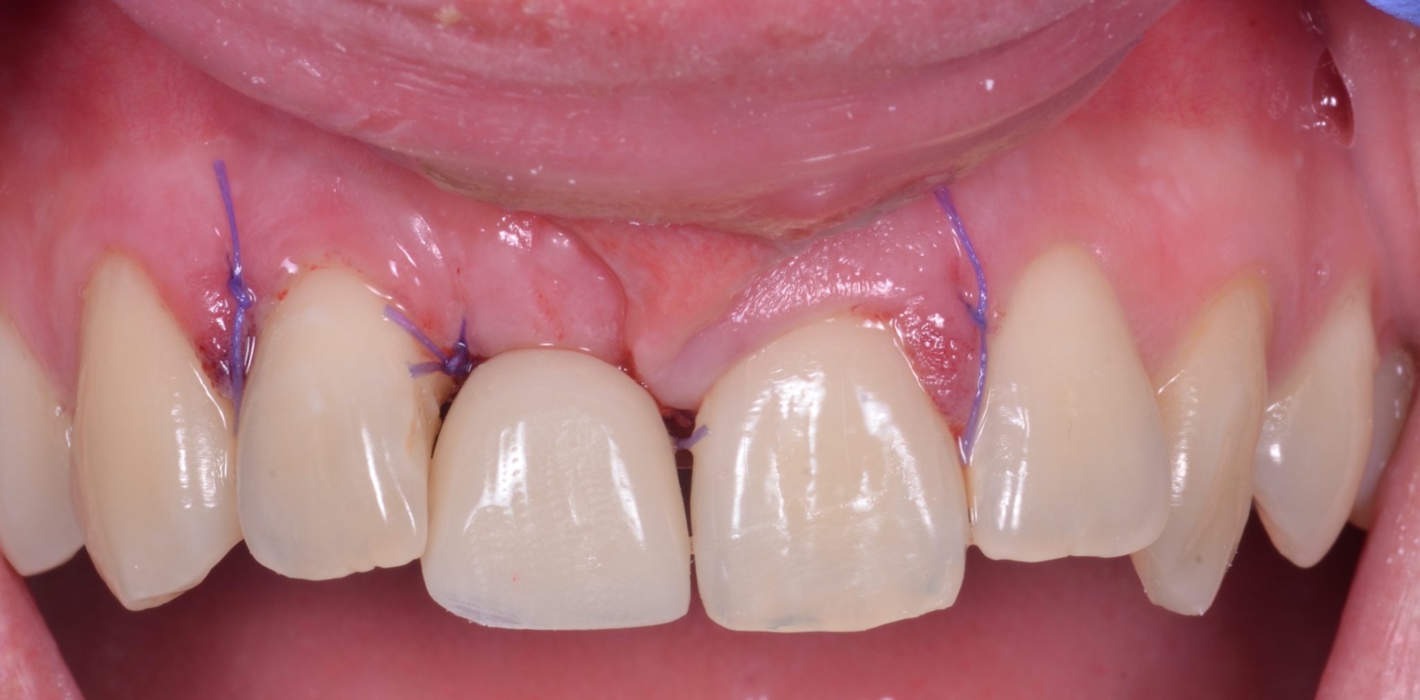 Zirconia dental implants in daily practice - ITI Blog