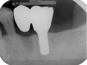 The use of cantilever extensions in partial implant-supported fixed ...