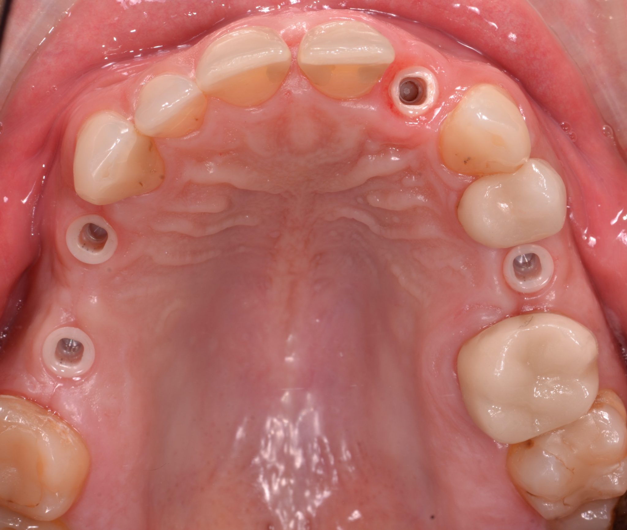 Zirconia dental implants in daily practice - ITI Blog