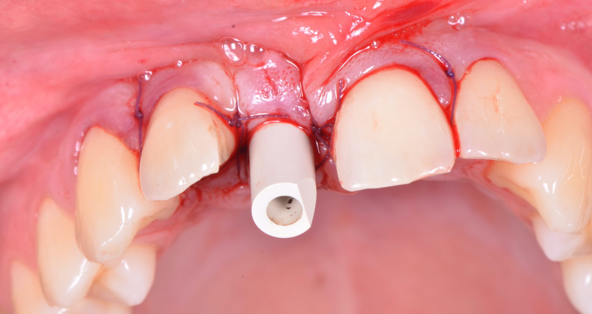 Zirconia dental implants in daily practice - ITI Blog