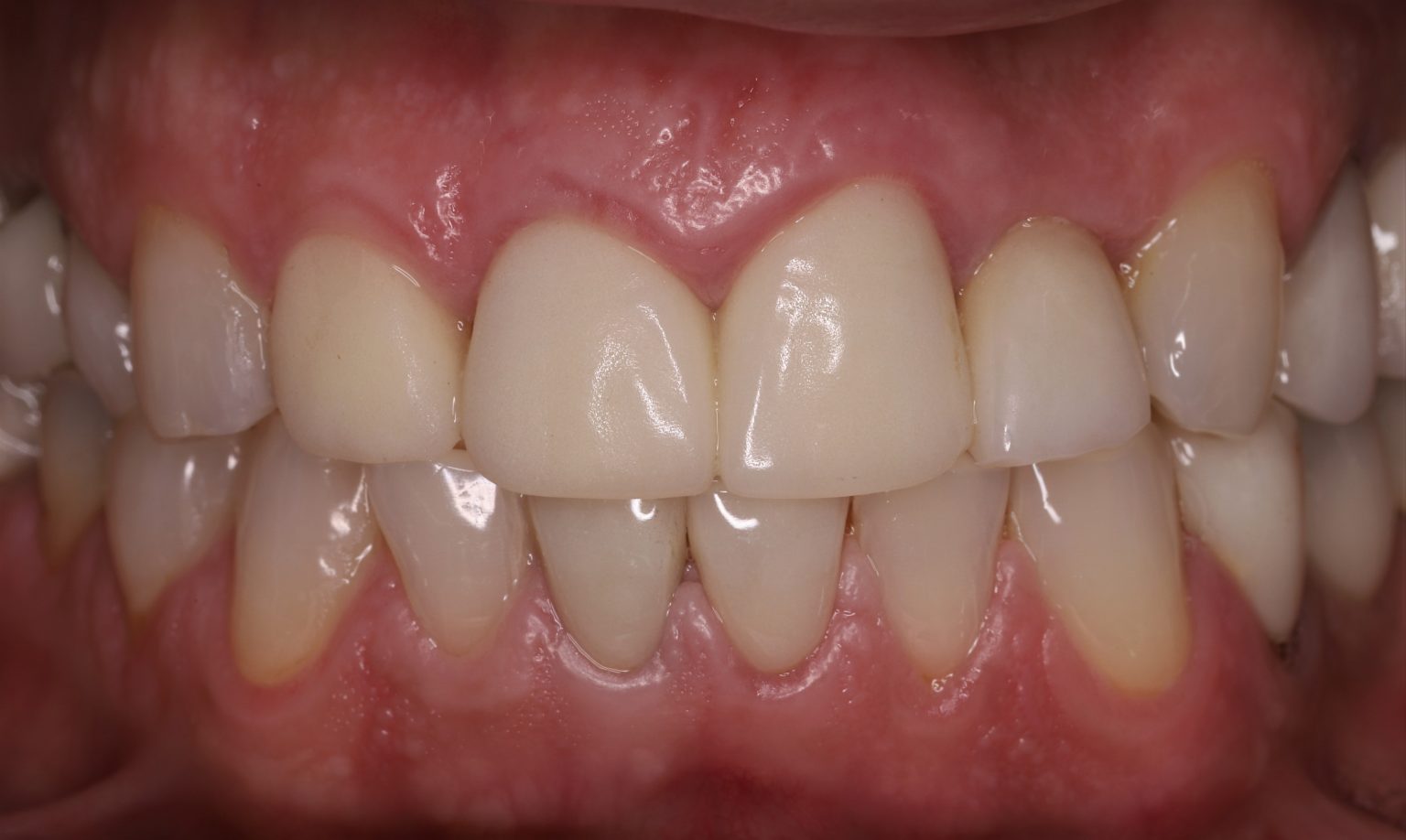 Socket shield therapy: when, where & how? - ITI Blog