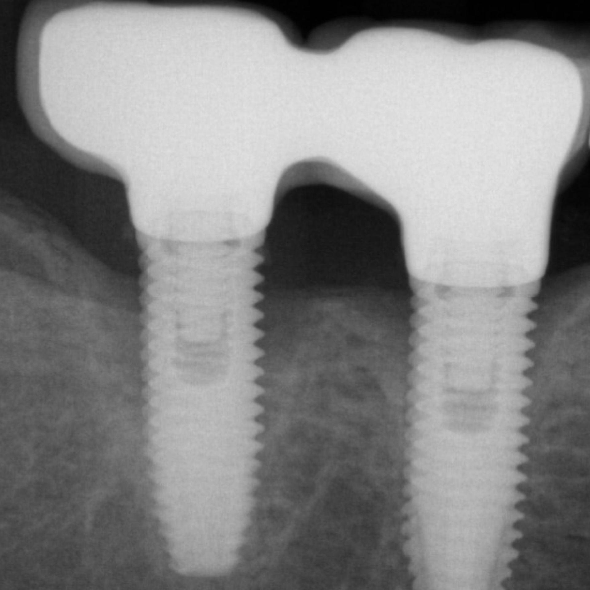 Surgical Therapeutic Modalities of Peri-Implantitis - ITI Blog