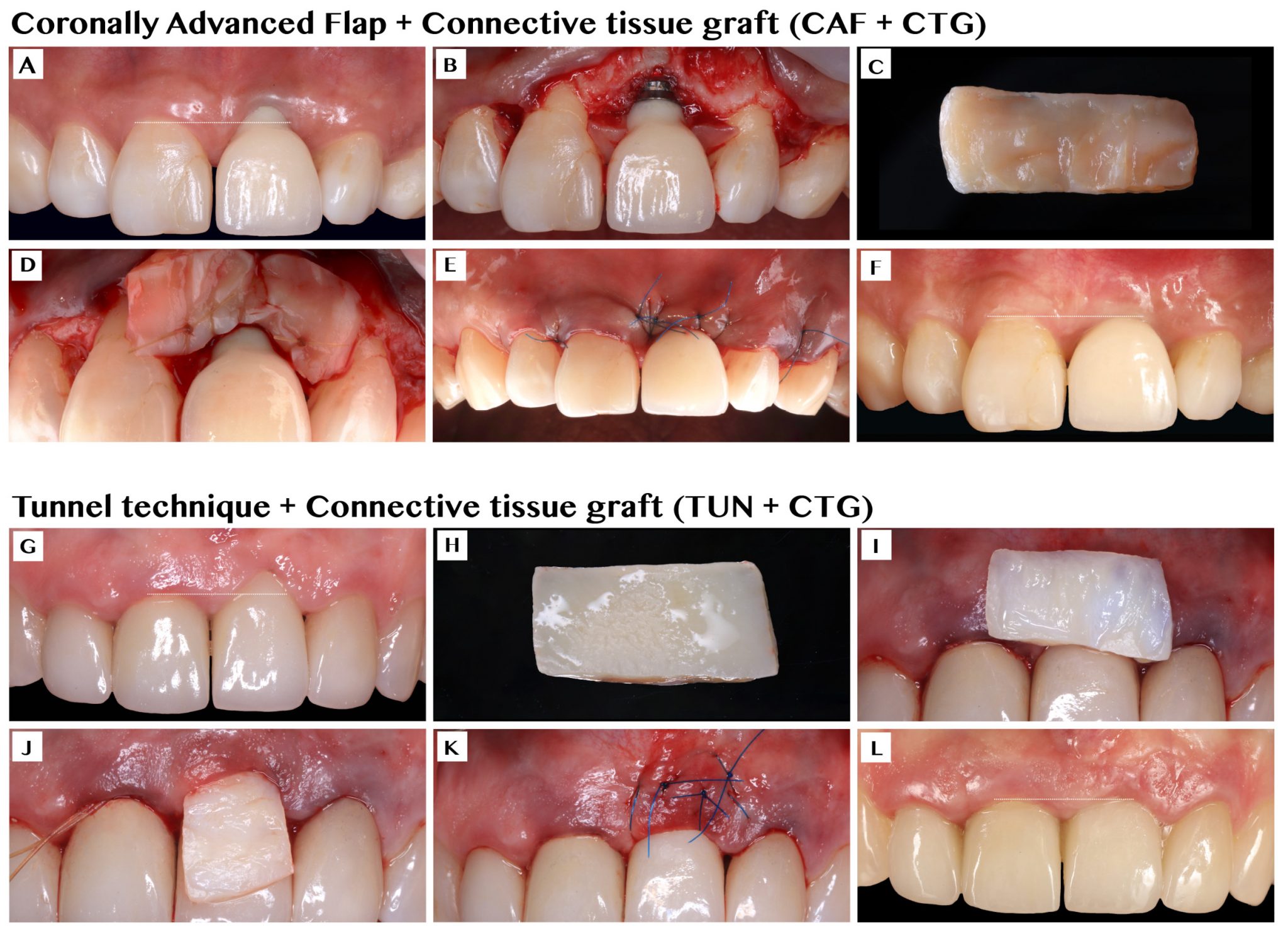 Implant esthetic complications in the anterior region. And now? - ITI Blog