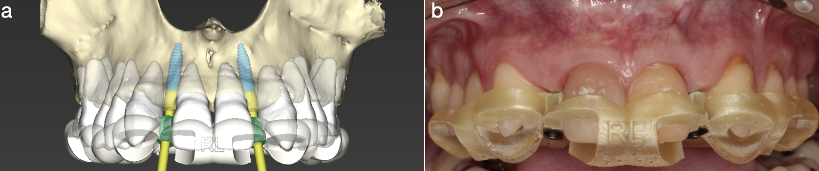Optimizing Static Computer-Assisted Implant Surgery: Guide Design ...