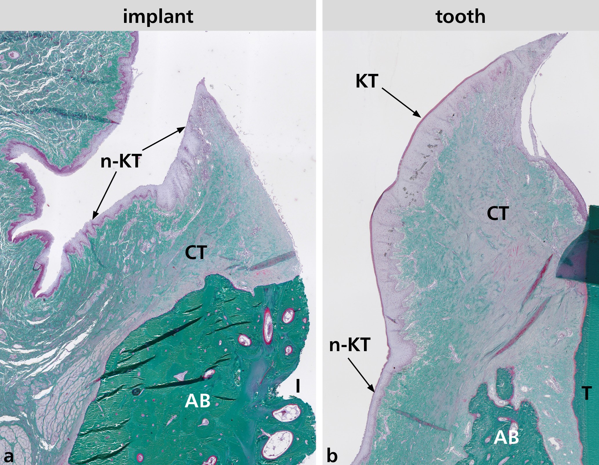 The importance of soft tissues around dental implants - ITI Blog