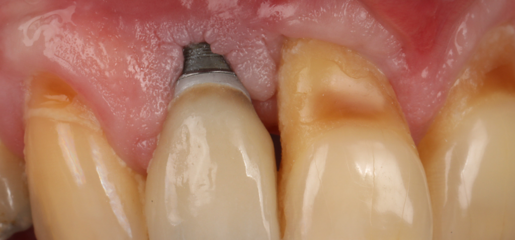 Implant esthetic complications in the anterior region. And now? - ITI Blog