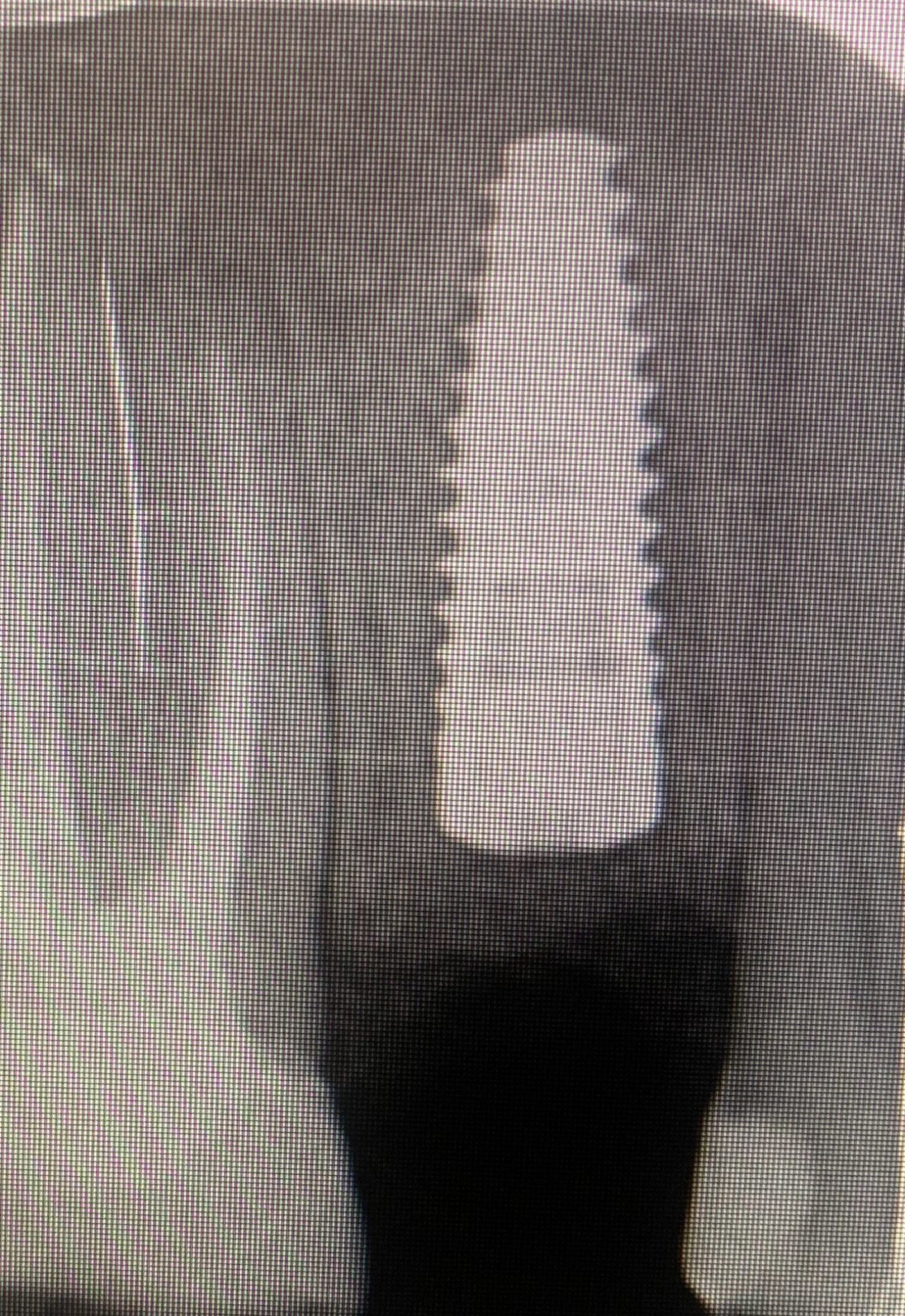 The devil is in the details: case selection for optimal implant ...