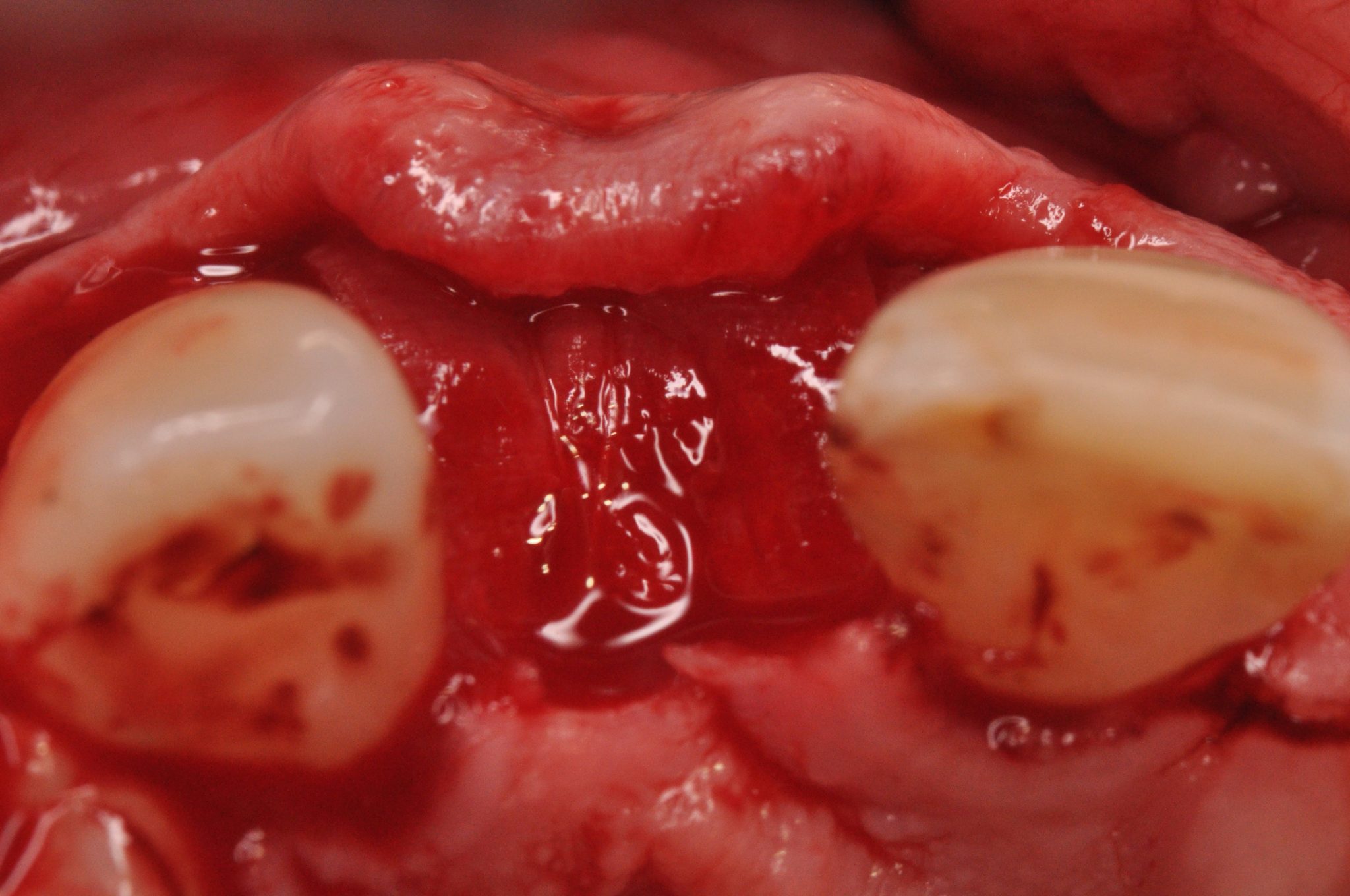 The devil is in the details: case selection for optimal implant ...