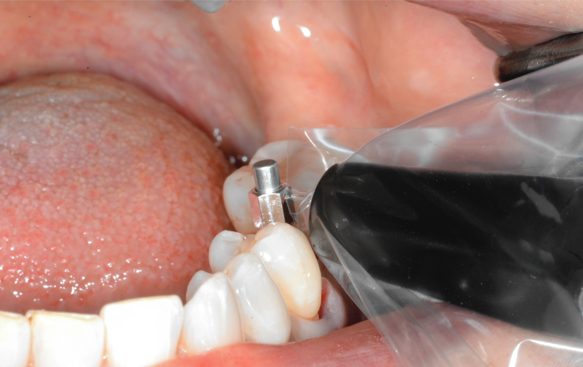 Implementing contemporary digital imaging and CAD-CAM technologies to ...