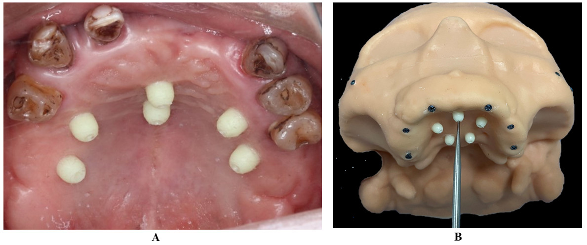 Registration Methods in Fully and Partially Edentulous Patients for ...