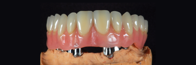 Can We Prevent Peri-Implantitis with an Adequate Prosthetic Design ...