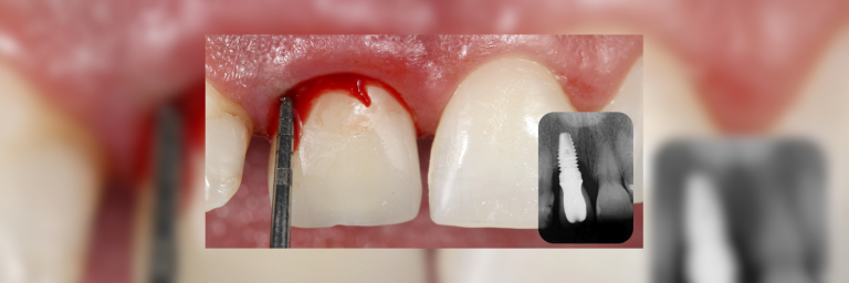 Interocclusal space assessment for full-arch implant-supported ...
