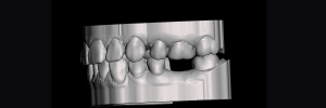 Interocclusal space assessment for full-arch implant-supported ...