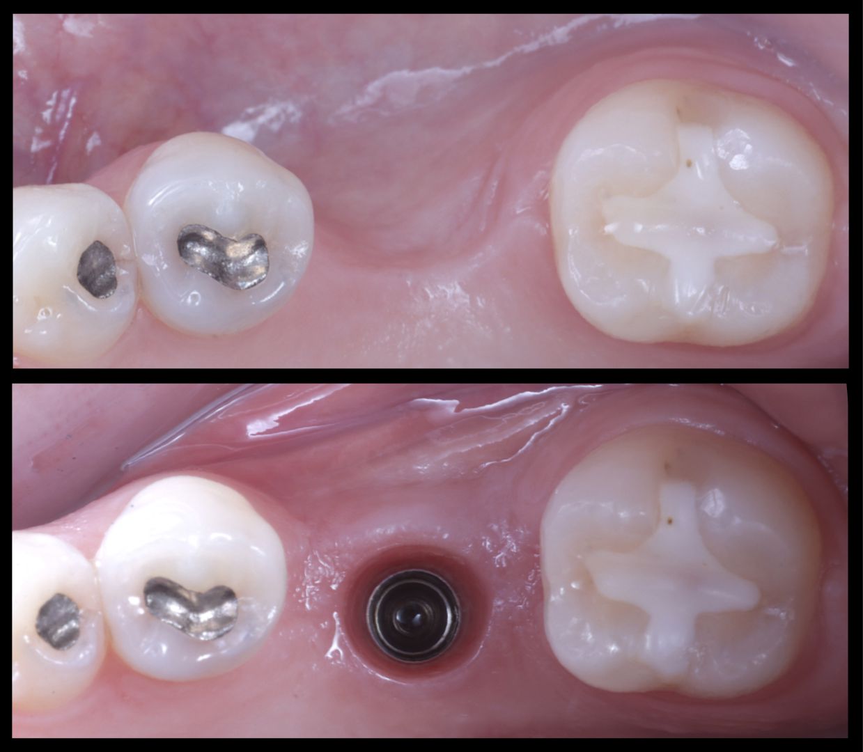 Digital trends and 3D technologies in bone augmentation procedures ...