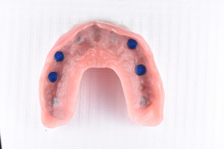 Choosing the correct overdenture attachments when dealing with ...