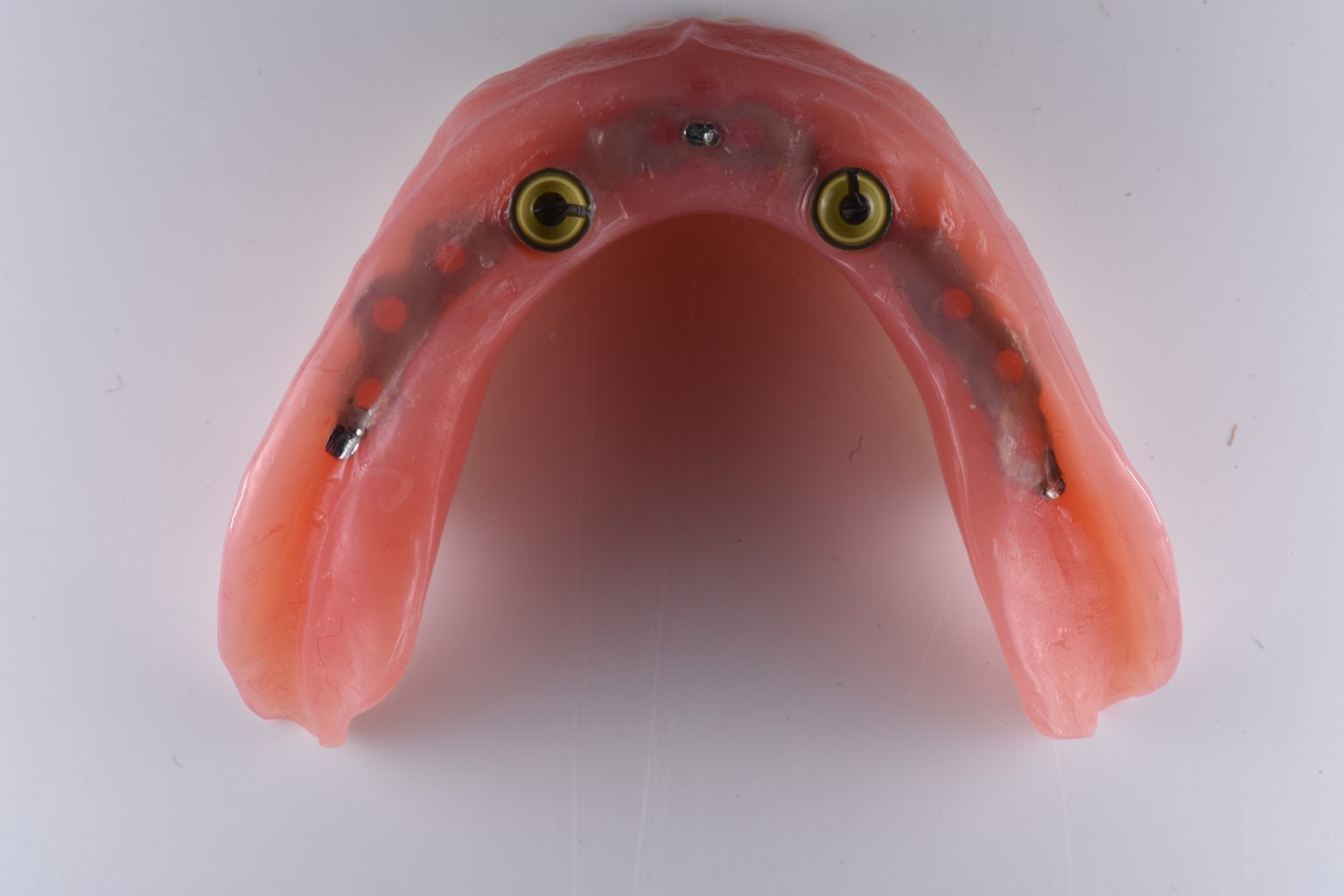 Choosing The Correct Overdenture Attachments When Dealing With