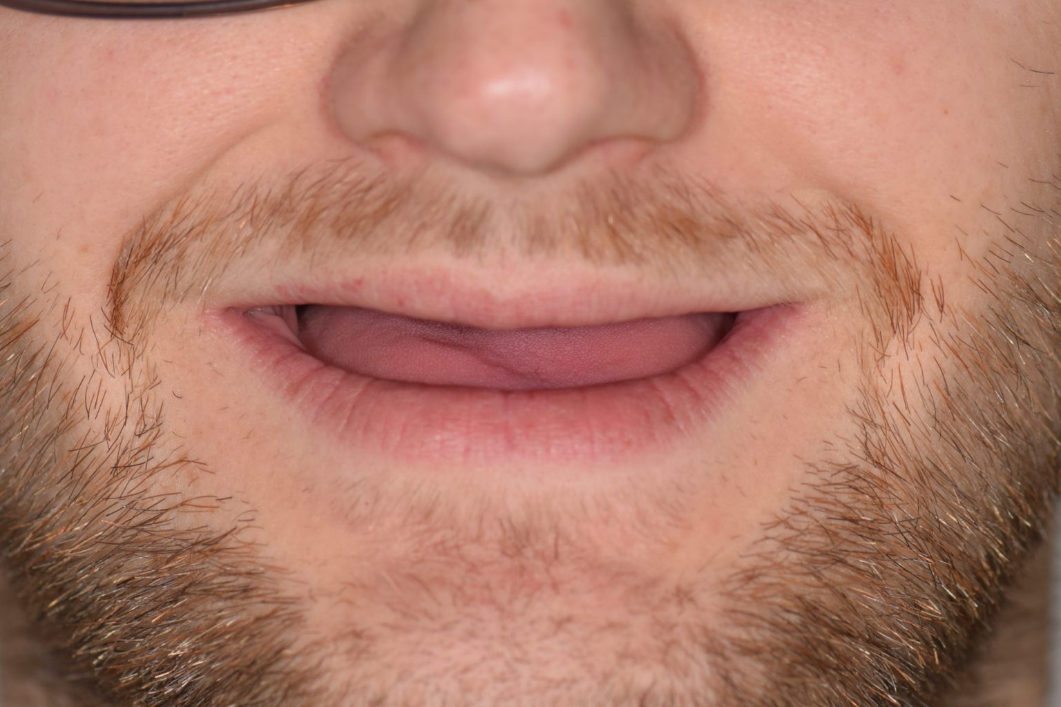 Choosing the correct overdenture attachments when dealing with ...