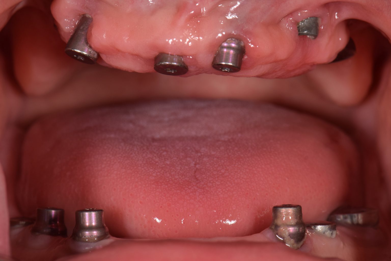 Choosing The Correct Overdenture Attachments When Dealing With