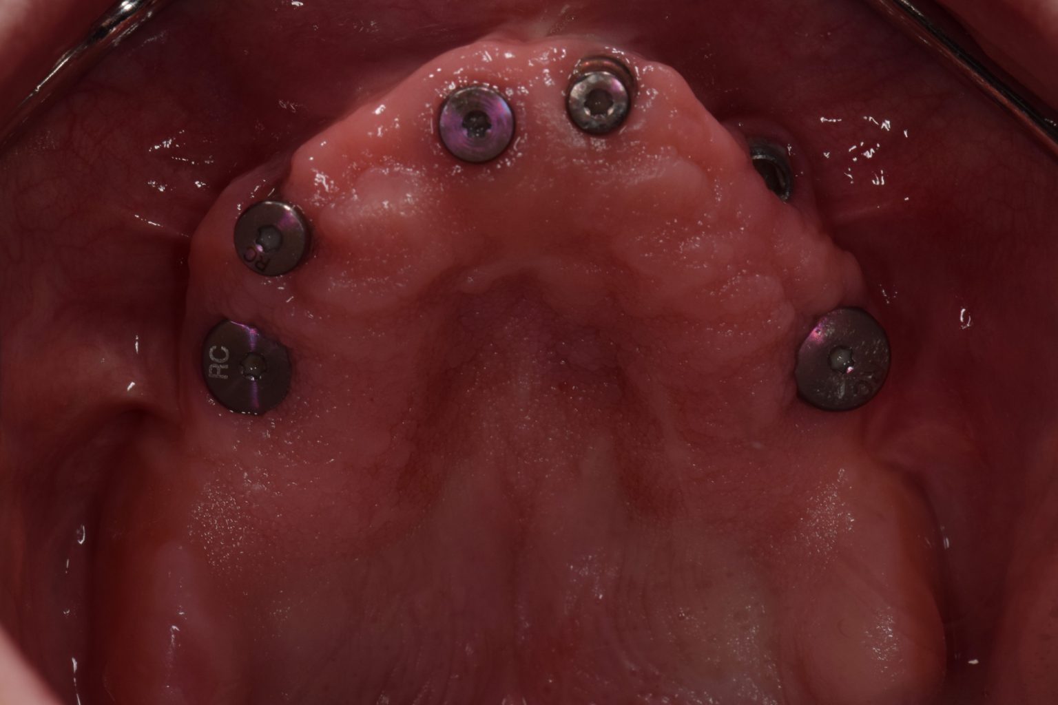 Choosing the correct overdenture attachments when dealing with ...