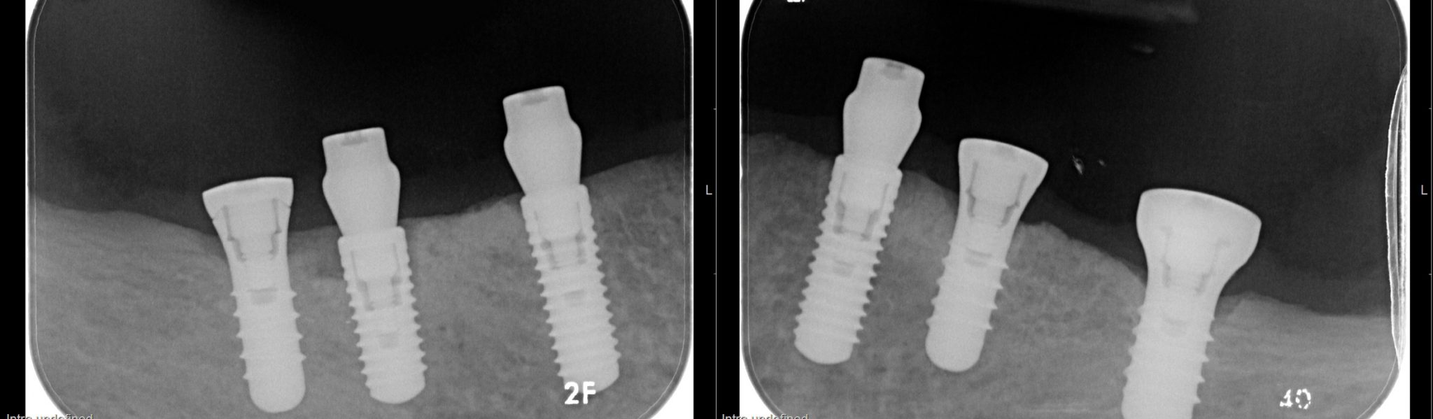 Choosing the correct overdenture attachments when dealing with ...