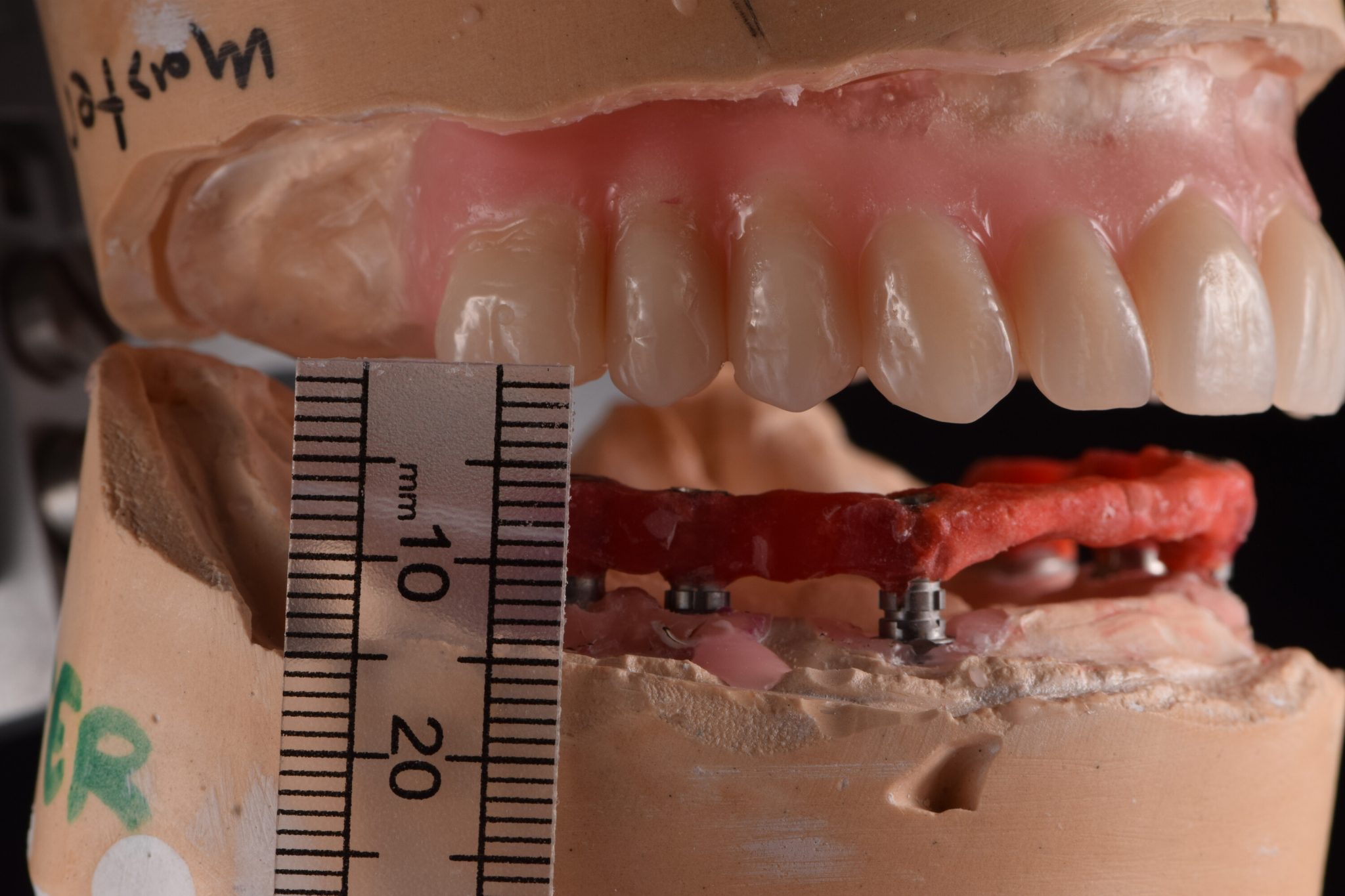 Choosing the correct overdenture attachments when dealing with ...