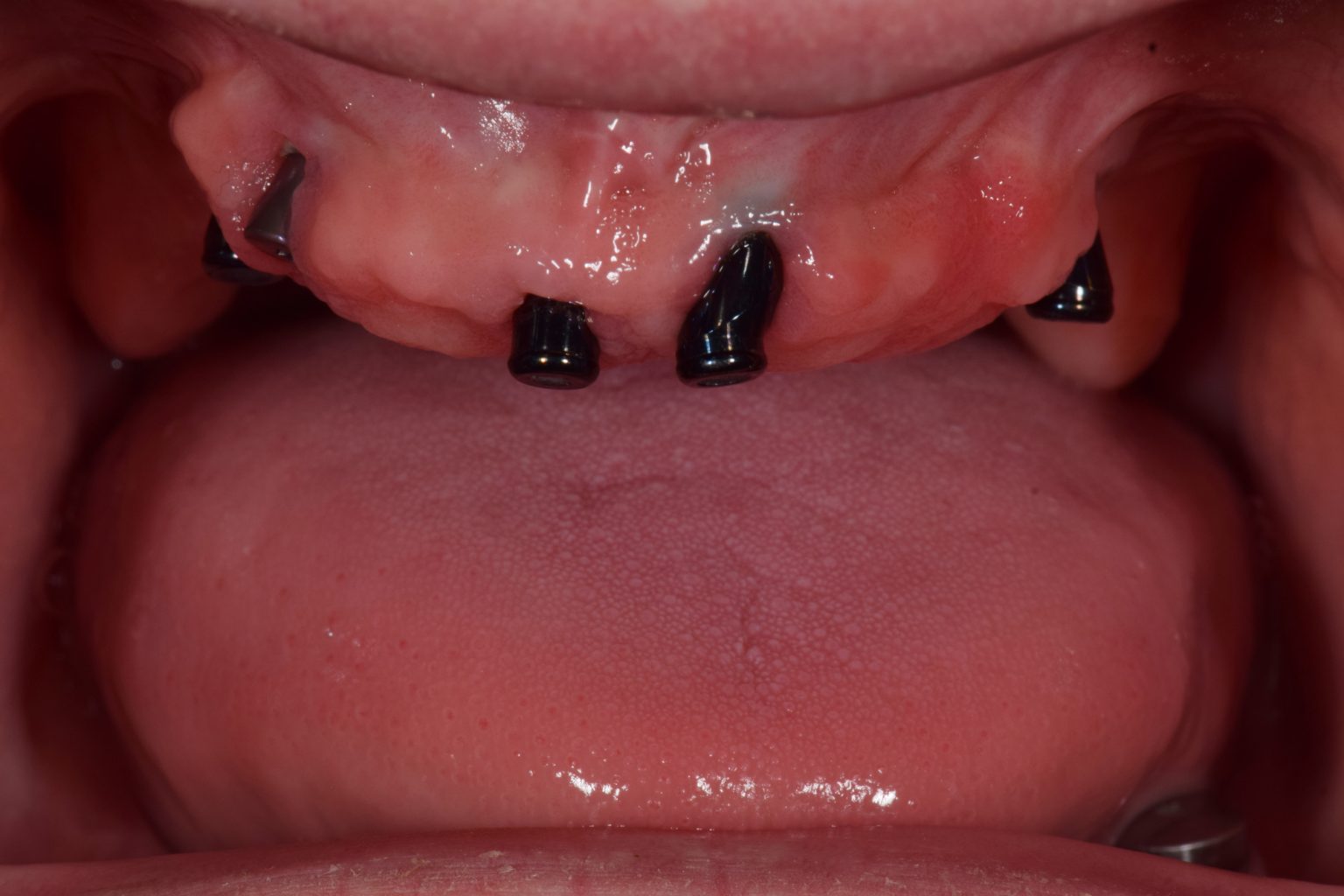 Choosing the correct overdenture attachments when dealing with ...