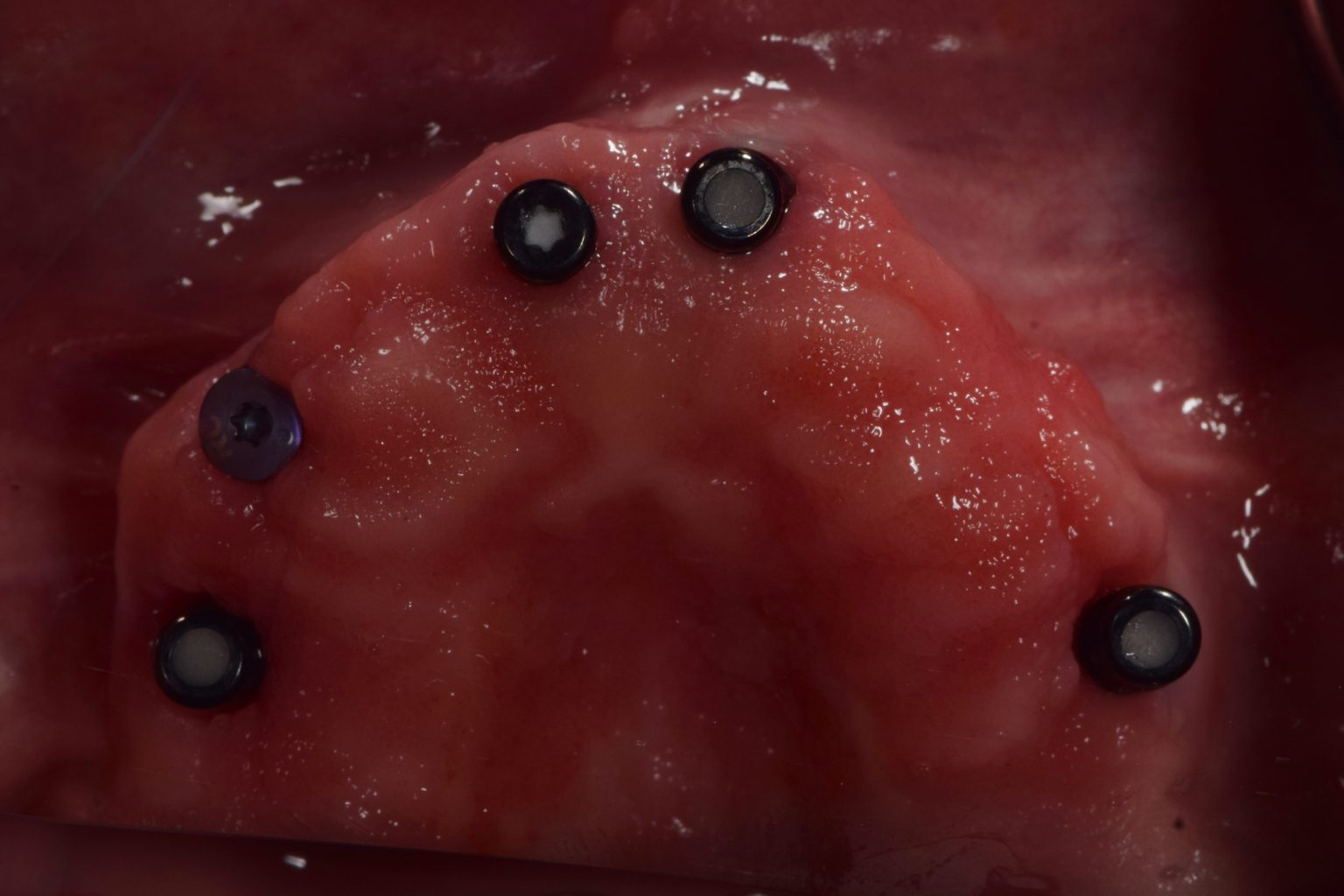 Choosing the correct overdenture attachments when dealing with ...