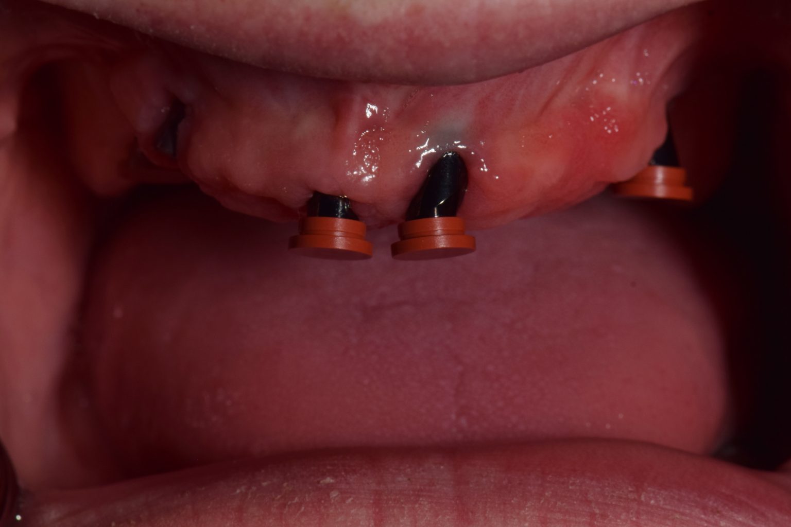 Choosing The Correct Overdenture Attachments When Dealing With