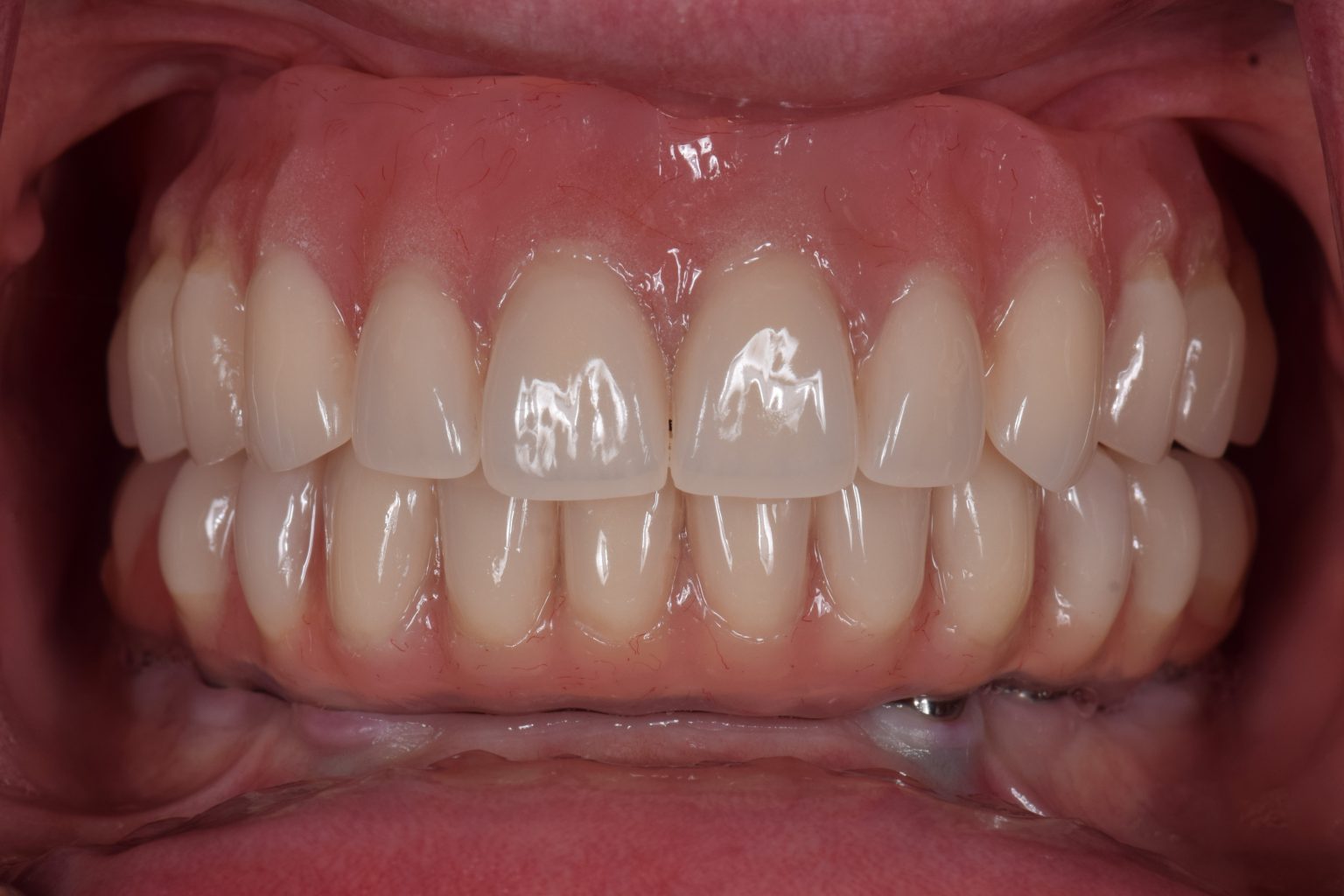 Choosing the correct overdenture attachments when dealing with ...